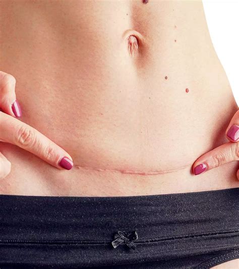 Types Of C Section Incisions Incision Site Infected With Cryptococcus