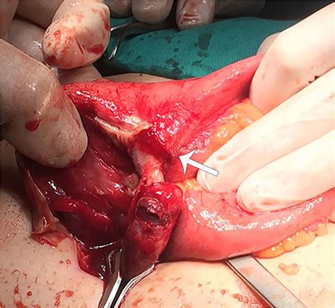 Intra Operative Image Where An Acutely Inflammed Appendix Entered And Download Scientific