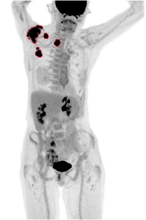 Bridging Radiotherapy Gross Tumor Volume Red For A Patient With