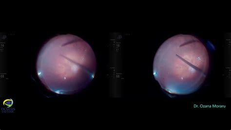 Rhegmatogenous Retinal Detachment With Choroidal Detachment Pp Vitrectomy With Silicone Oil