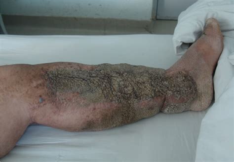 The Patient Had A Congenital Lymphedema Of Left Lower Limb For More