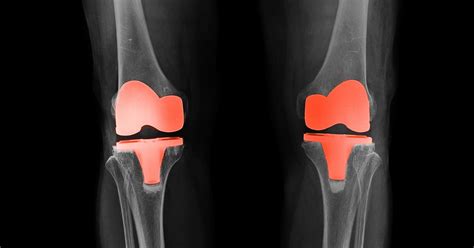 Beyond Surgery Exploring Alternative To Knee Replacements