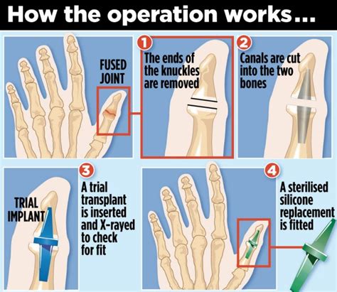 A New Thumb Joint Thatl Do The Trick Daily Mail Online