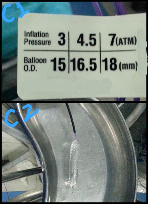 Ercp And Egd Multiple Cbd Stones Requiring Different Removal Techniques