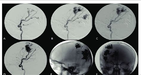 Multiple Embolization Sessions First Session With Onyx Showing