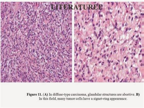 Reza Aditya Digambiro GASTRIC SIGNET RING CELL CARCINOMA