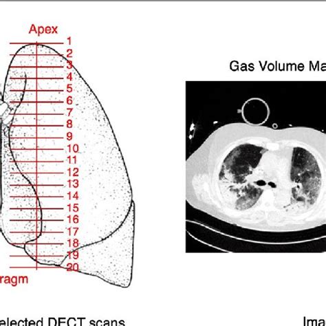 Dual Energy Computed Tomography Dect Image Acquisition And Analysis