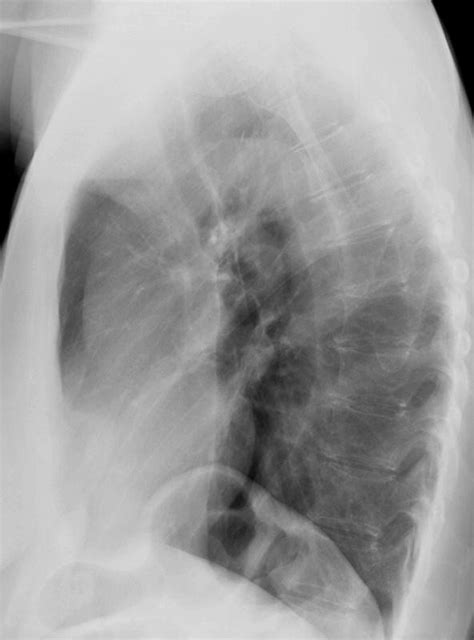 Scleroderma Esophagus