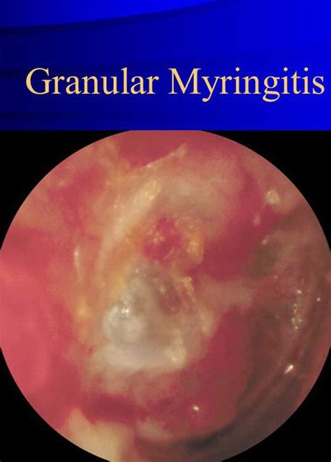 Granular Myringitis