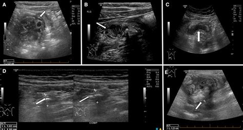 Ruptured Appendix Ultrasound