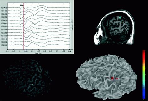 Magnetoencephalography And Magnetic Source Modeling Neupsy Key