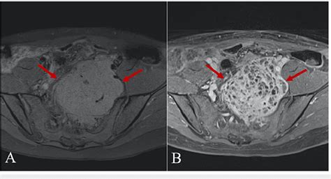 T1 Weighted Fat Saturated Axial A And Contrast Enhanced Axial B Mri