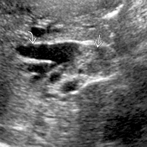 Cholangiocarcinoma Radiology Key
