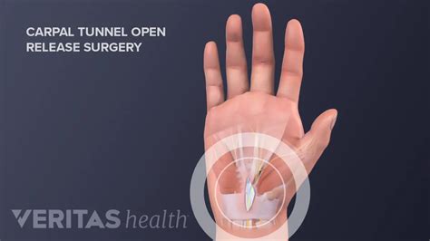 Can I Use My Hand After Carpal Tunnel Surgery