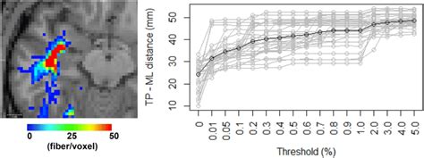 Left Fibers Density Of The Meyers Loop In A Healthy Subject Right