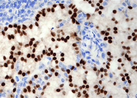 8 Acinic Cell Carcinoma Sox10 Immunostain Showing Strong Nuclear