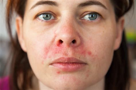 Perioral Dermatitis Treatment In Terre Haute And Vincennes Biltmore