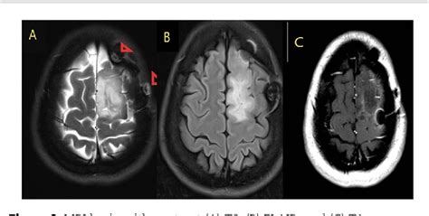 Figure 1 From Anesthesia For Awake Craniotomy A Case Report Semantic Scholar