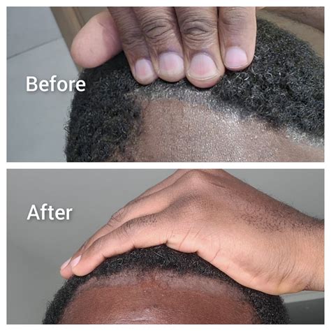 Rosemary Oil Miracle For Scalp Psoriasis Rpsoriasis