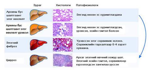 Элэгний өөхлөлттэй хүмүүс ямар арга хэмжээ авах шаардлагатай вэ “ЦАХИУР ТӨМӨР” ХХК
