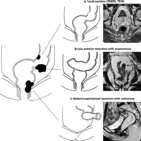 Pdf Mri Anatomy Of The Rectum Key Concepts Important For Rectal