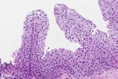 Low Grade Non Invasive Papillary Urothelial Carcinoma Ottawa Atlas Of