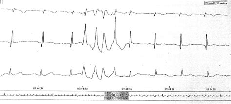 Holter Ecg Monitoring Unstable Paroxysm Of Polymorphic Ventricular