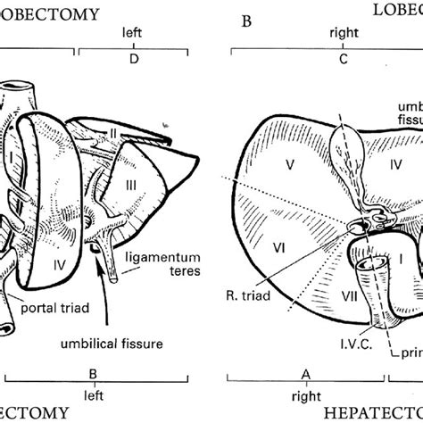 Commonly Performed Hepatic Resections Shown In The Shaded Areas A