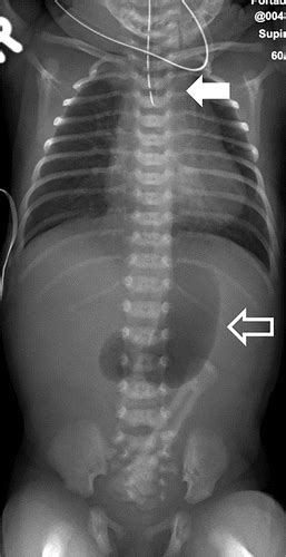 Imaging Features Of Neonatal Bowel Obstruction Radiographics