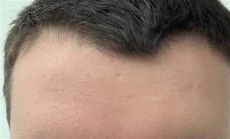 Can Minoxidil Regrow Miniaturized Hairs That Stopped Growing Rminoxidil