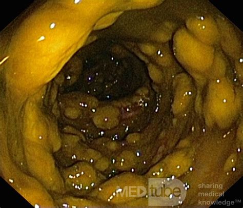 Endoscopic Appearance Of The Pseudomembranous Colitis • Image •