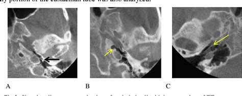 Figure 2 From Classification And Volumetric Analysis Of Temporal Bone Pneumatization Using Cone