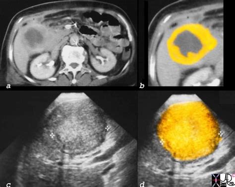 Ultrasound The Common Vein
