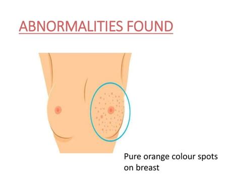 Breast Self Examination And Abnormalities Pptx