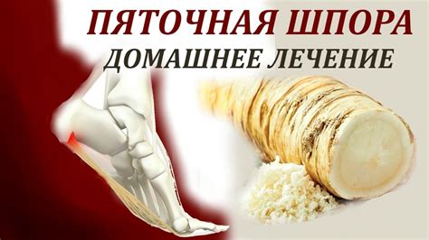 ПЯТОЧНАЯ ШПОРА Лечение Пяточной Шпоры Народными средствами в Домашних Условиях Youtube