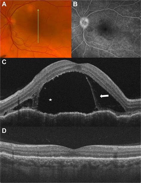 Ophthalmology Retina Oct Lymphoma Cancer George Magrath