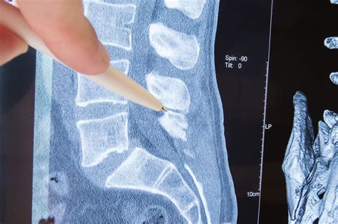 An Introductory Guide To Spinal Stenosis Surgery Howell Allen Clinic
