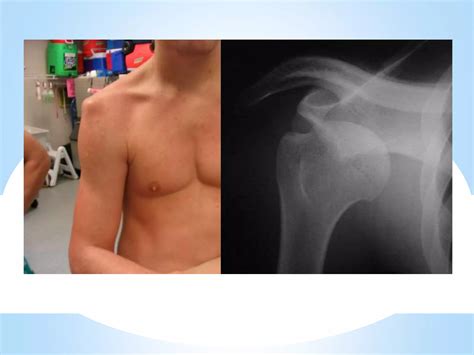 Shoulder Sports Related Injuries Pptx