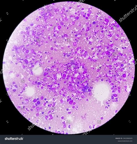 Photomicrograph Bone Marrow Study Megakaryocytic Hyperplasia Stock