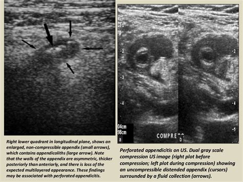 Presentation1 Pptx Ultrasound Examination Of The Appendix