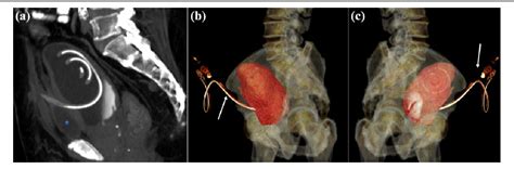 Figure From The Peritoneal Dialysis Catheter Urine Trouble Semantic Scholar