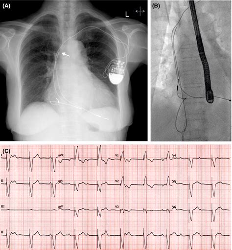 Pots Syndrome Pacemaker At John Tabarez Blog