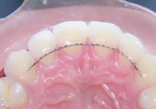 Retainers PMA Dental Care Dentist Gravesend Kent