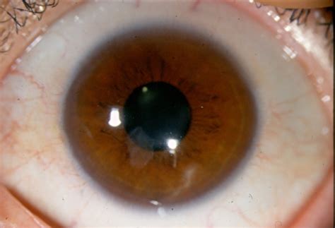 Ntm Atypical Keratitis Parasite
