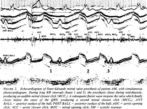 Figure 2 From Mitral Valve Closure In Atrial Flutter Semantic Scholar