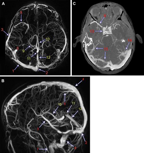 Imaging The Cerebral Veins In Pediatric Patients Beyond Dural Venous