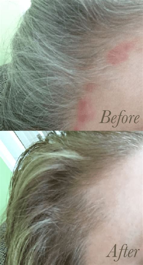 Before And After What Shannon Did To Get Rid Of Sensitive Skin And Red