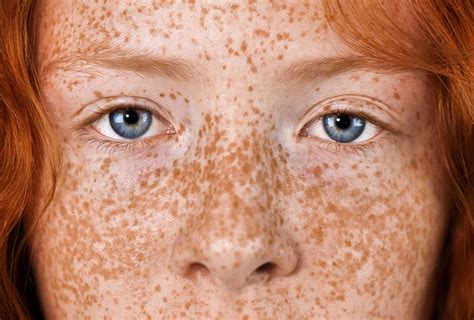 Les Taches De Rousseur Comment Les Effacer
