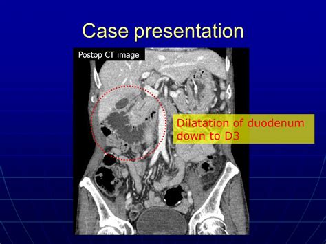 The Management Of Sma Syndrome Ppt Download
