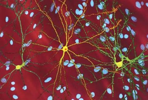 Insidious Neurologic Deterioration In A Year Old Woman Case Quiz